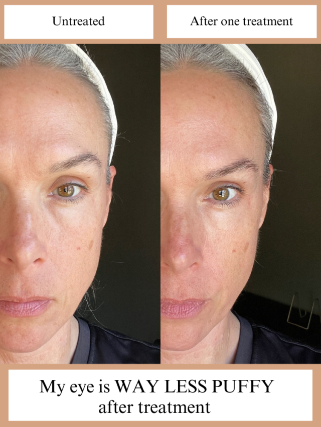 The NuFace Trinity is Good but the MINI+ is Better (Before + Afters ...