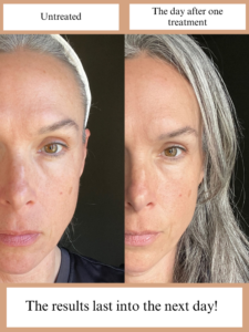 The NuFace Trinity is Good but the MINI+ is Better (Before + Afters ...