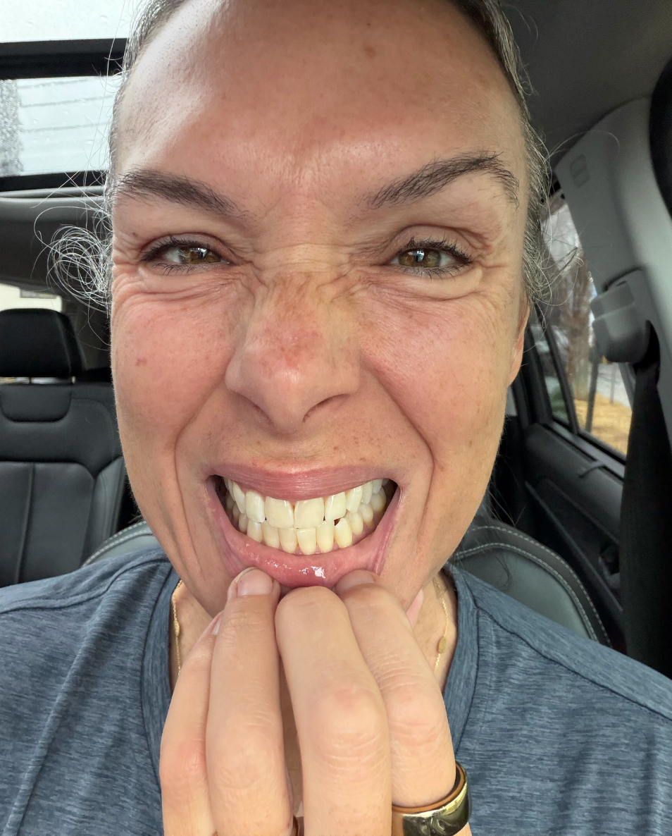 Zoom Whitening Review: 5 Things I Wish I Knew Before Getting It - The ...